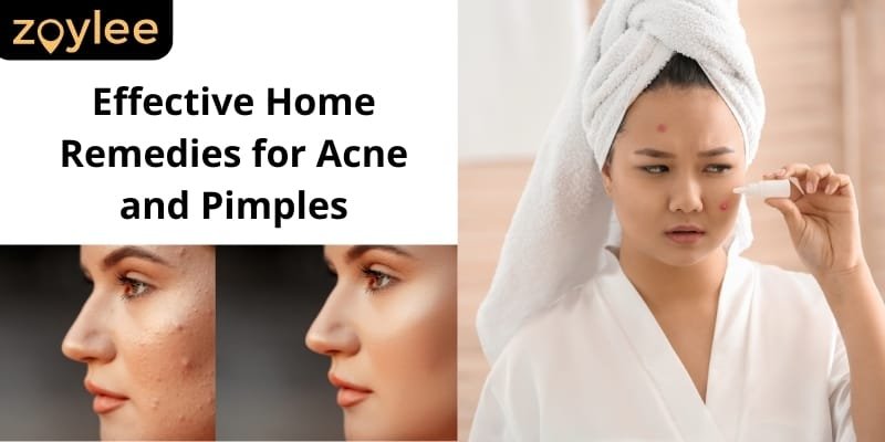 Effective Pimple Home Remedies: Clear Acne Skin Tips